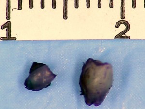 LEEP biopsy Archives - GROSSING TECHNOLOGY in SURGICAL PATHOLOGY